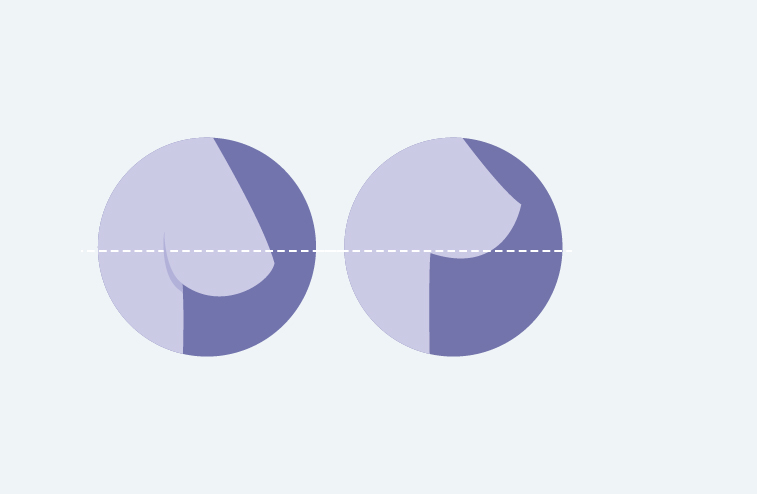 Mastopexy Augmentation - Soft Tissue Support